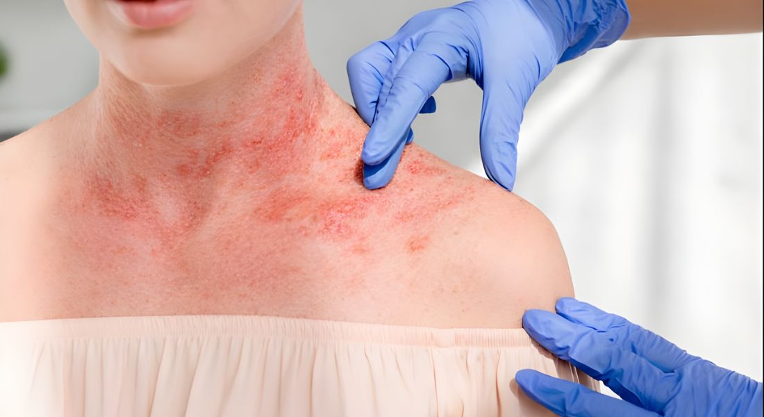 Th2 Inflammation in Eczema Explained (Science)