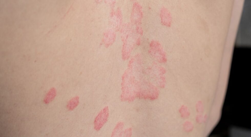 Unclear Skin Conditions: How Dermatologists Diagnose (Guide)