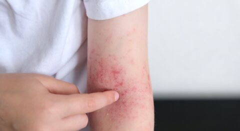 Cutaneous Drug Reactions Explained (Clinical)