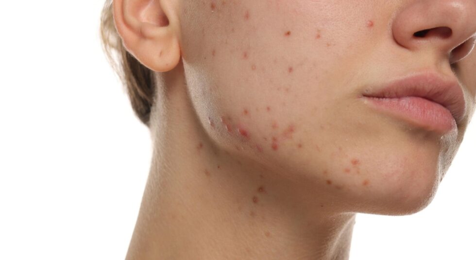 PCOS & Skin Problems: Acne, Pigmentation & Hair Growth