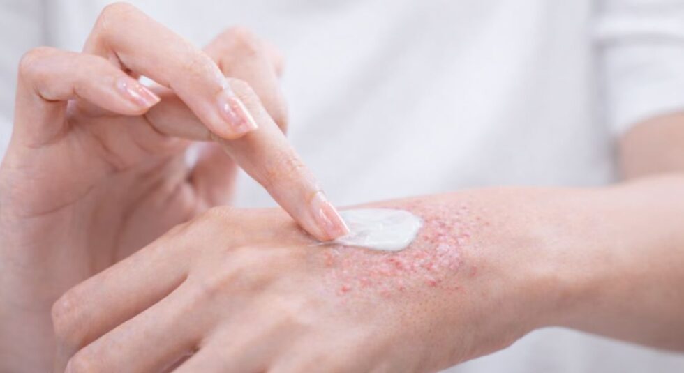 Cutaneous Drug Reactions Explained (Clinical)