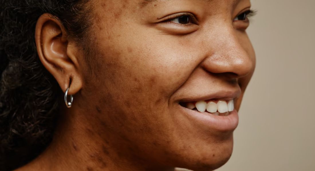 Acne in Black Skin Explained