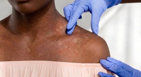 Eczema Pigmentation in Black Skin