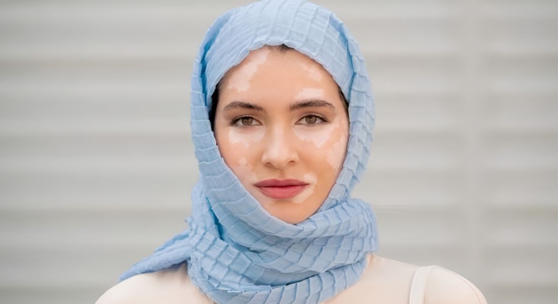 Vitiligo in Arabic Skin Explained