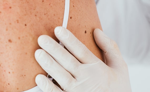 Skin Cancer Clinic London (Experienced Dermatologists)